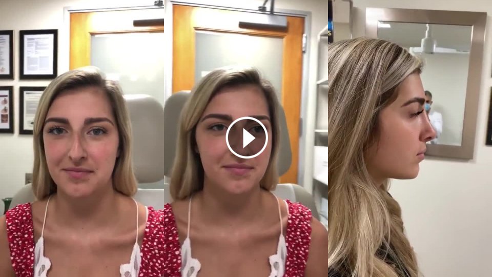 Plastická operácia nosa - Mojevideo